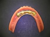 horak-zahntechnik.de | bildergalerie - galvano-steg-prothese